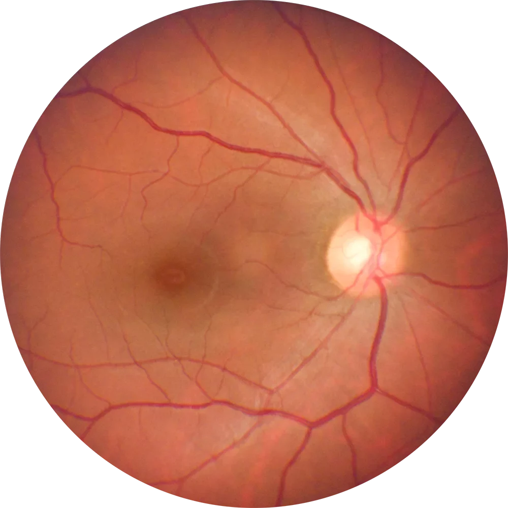 Portable Handheld Non-Mydriatic Fundus Camera | Remidio FOP-NM - Remidio