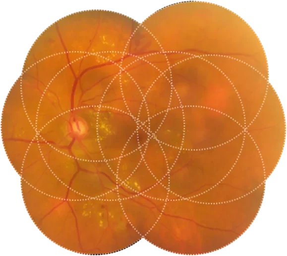 Portable Handheld Non-Mydriatic Fundus Camera | Remidio FOP-NM - Remidio